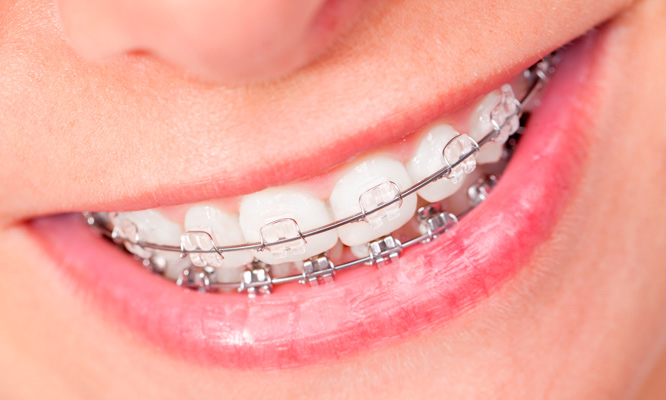 Miraflores: Brackets transparentes o métalicos | Cuponidad