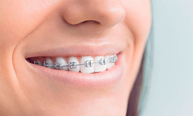 Miraflores: brackets metálicos + instalación + set de fotografías y más ...